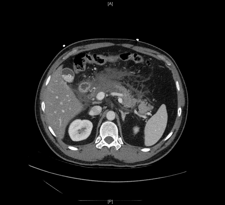 FIGURE 1. CT Results on Hospital Day 1